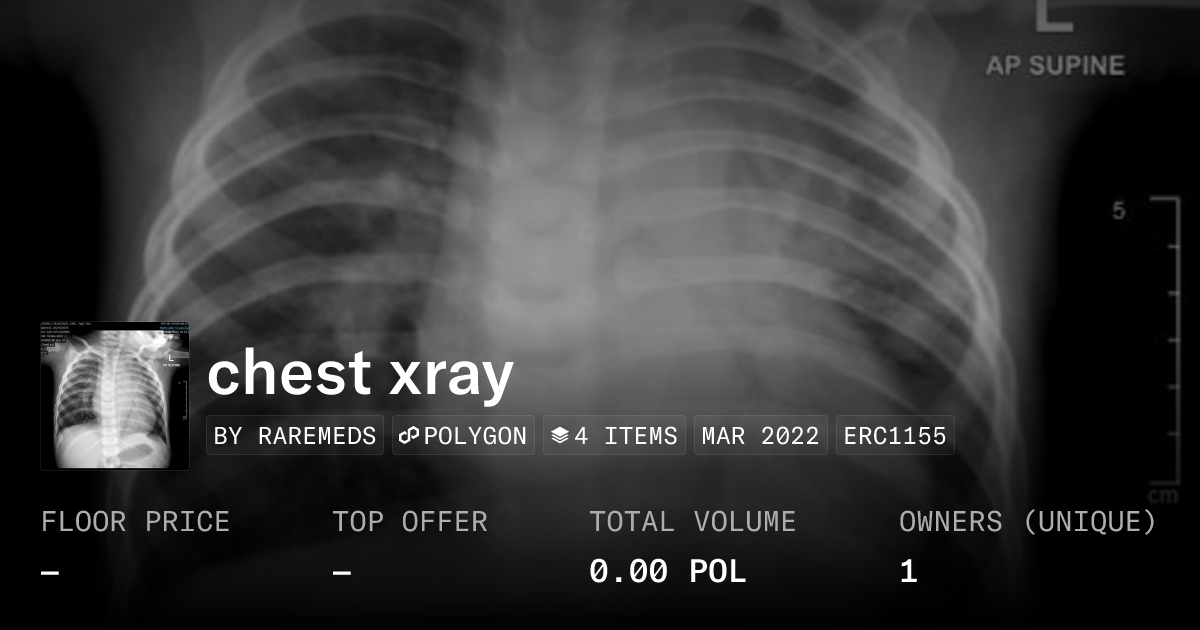 chest xray - Collection | OpenSea